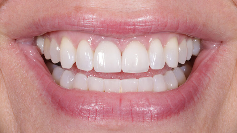 Smile Gallery - The Smile Architects - Newport, MN Dentist